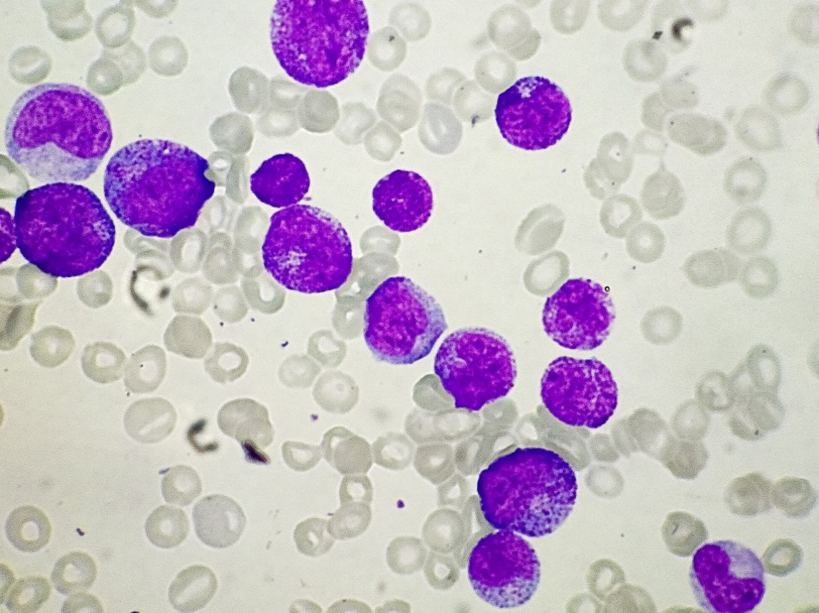 Leucemia mieloide acuta: più sopravvivenza con nuova cura - Sanihelp.it